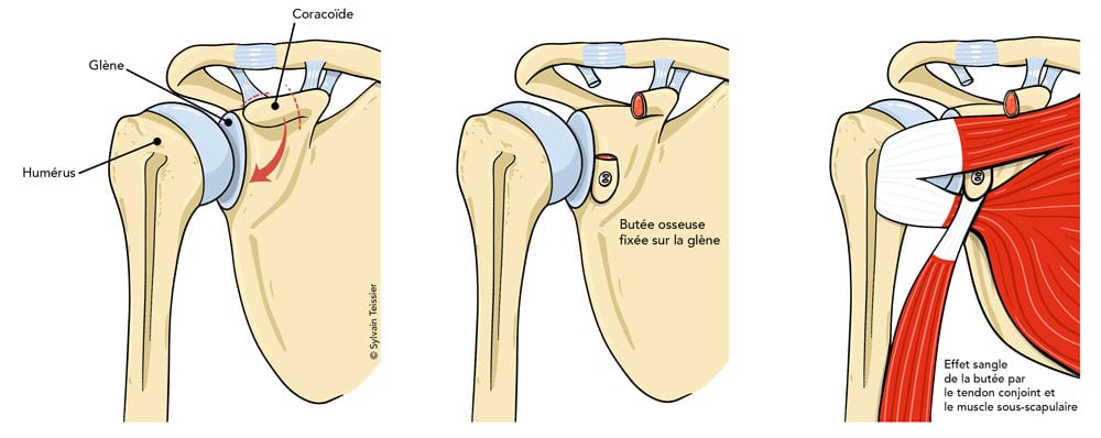 Opération de la butée Latarjet - Institut de Chirurgie Réparatrice ...