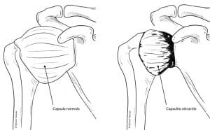Capsulite rétractile - Institut de Chirurgie Réparatrice Locomoteur & Sport