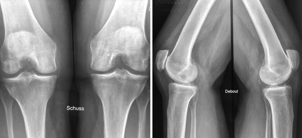 L'arthrose du genou - Institut de Chirurgie Réparatrice Locomoteur & Sport