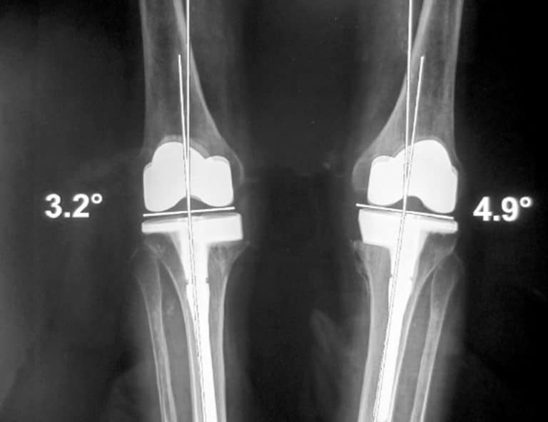 L'arthrose du genou - Institut de Chirurgie Réparatrice Locomoteur & Sport