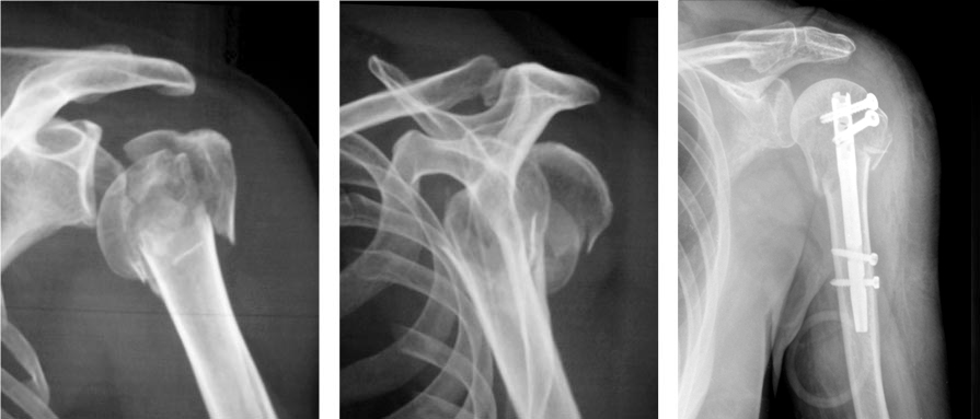 Clou d’humérus pour fracture