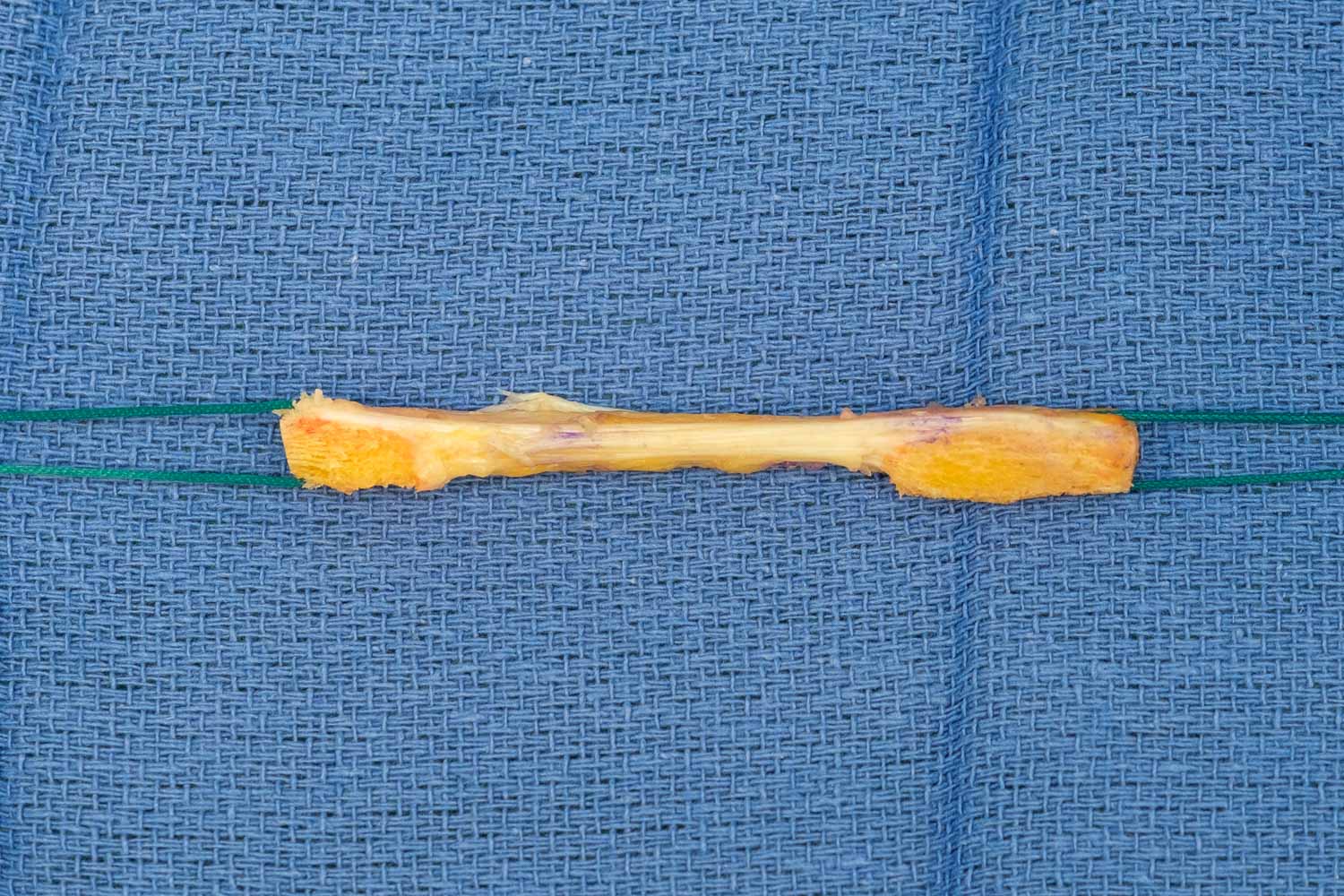 Greffe du ligament croisé antérieur au tendon patellaire prélevé au ...